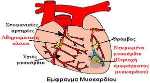 Οξύ Έμφραγμα Μυοκαρδίου - Προσέγγιση Ασθενούς με Θωρακικό Πόνο (Για ...
